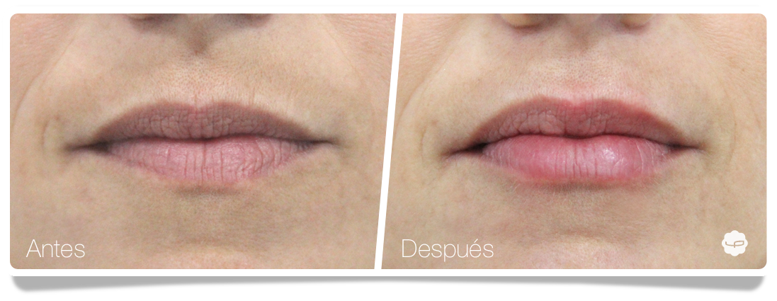 Aumento y/o perfilado de labios | Tratamiento de labios | Clínica Áureo