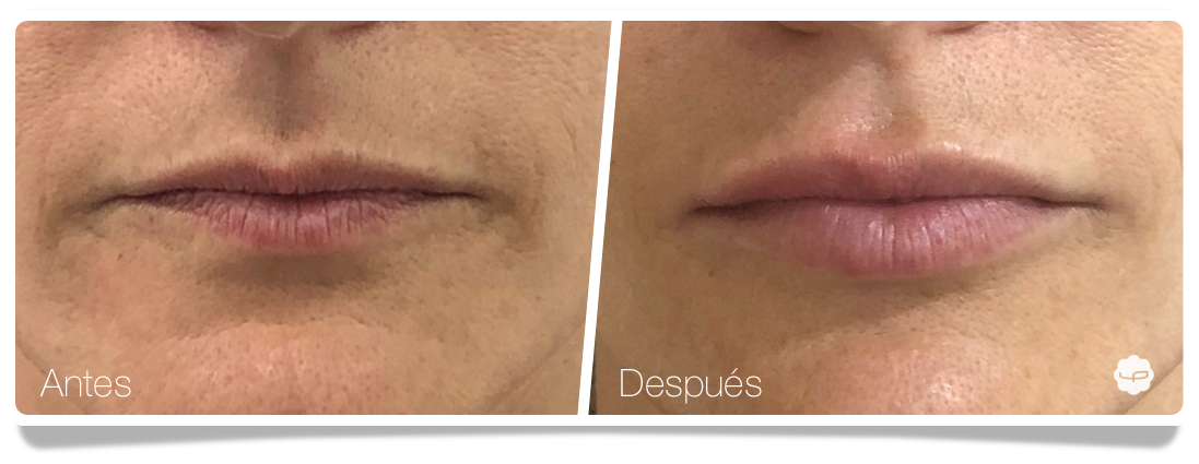 Aumento y/o perfilado de labios | Tratamiento de labios | Clínica Áureo