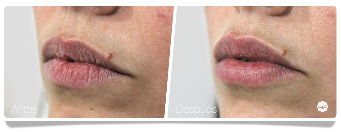 Aumento y/o perfilado de labios | Tratamiento de labios | Clínica Áureo