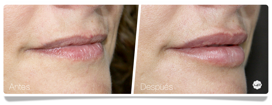 Aumento y/o perfilado de labios | Tratamiento de labios | Clínica Áureo
