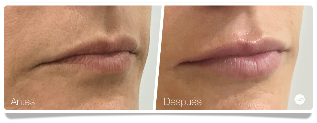 Aumento y/o perfilado de labios | Tratamiento de labios | Clínica Áureo